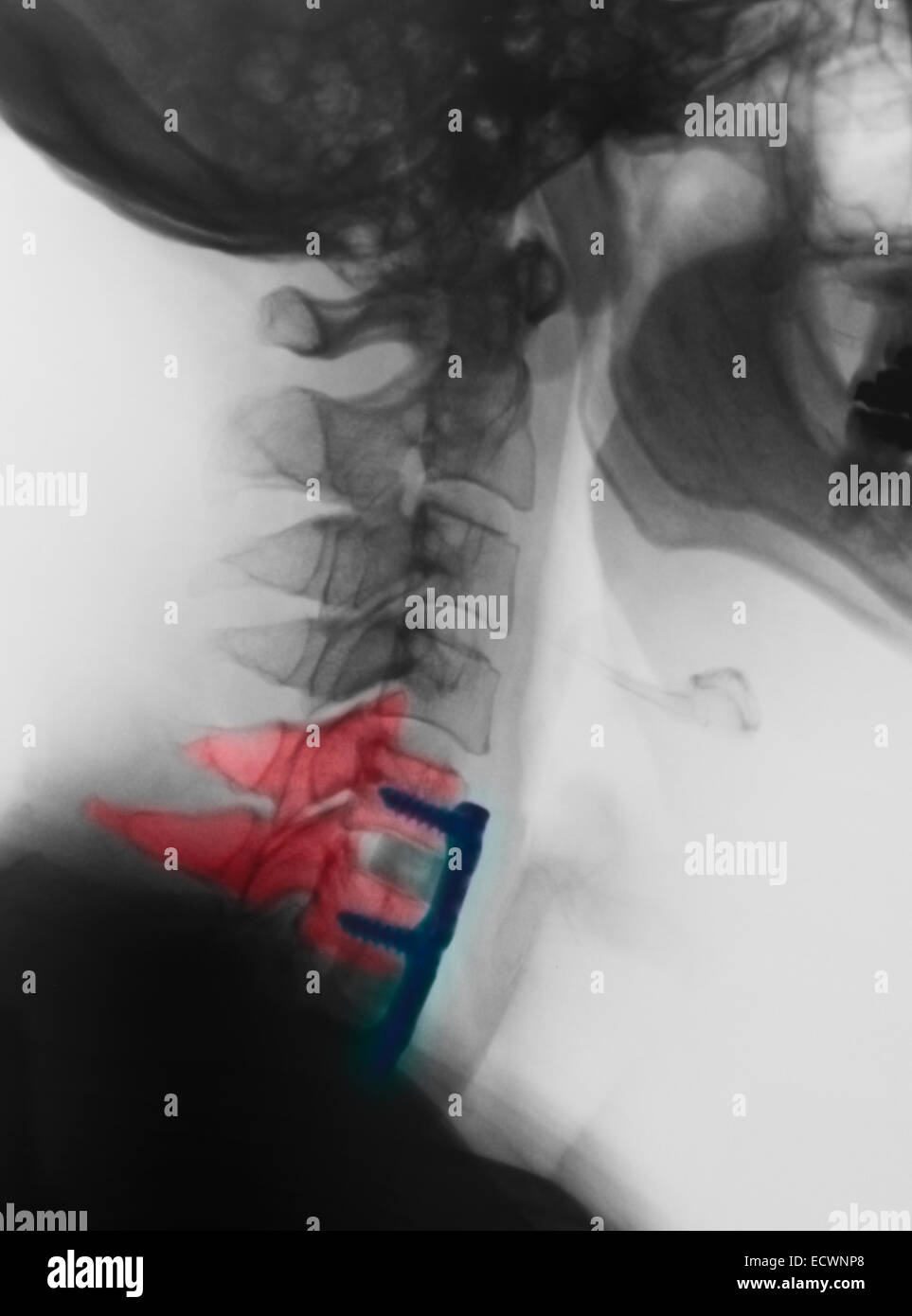 cervical neck x-ray showing spinal fusion Stock Photo - Alamy