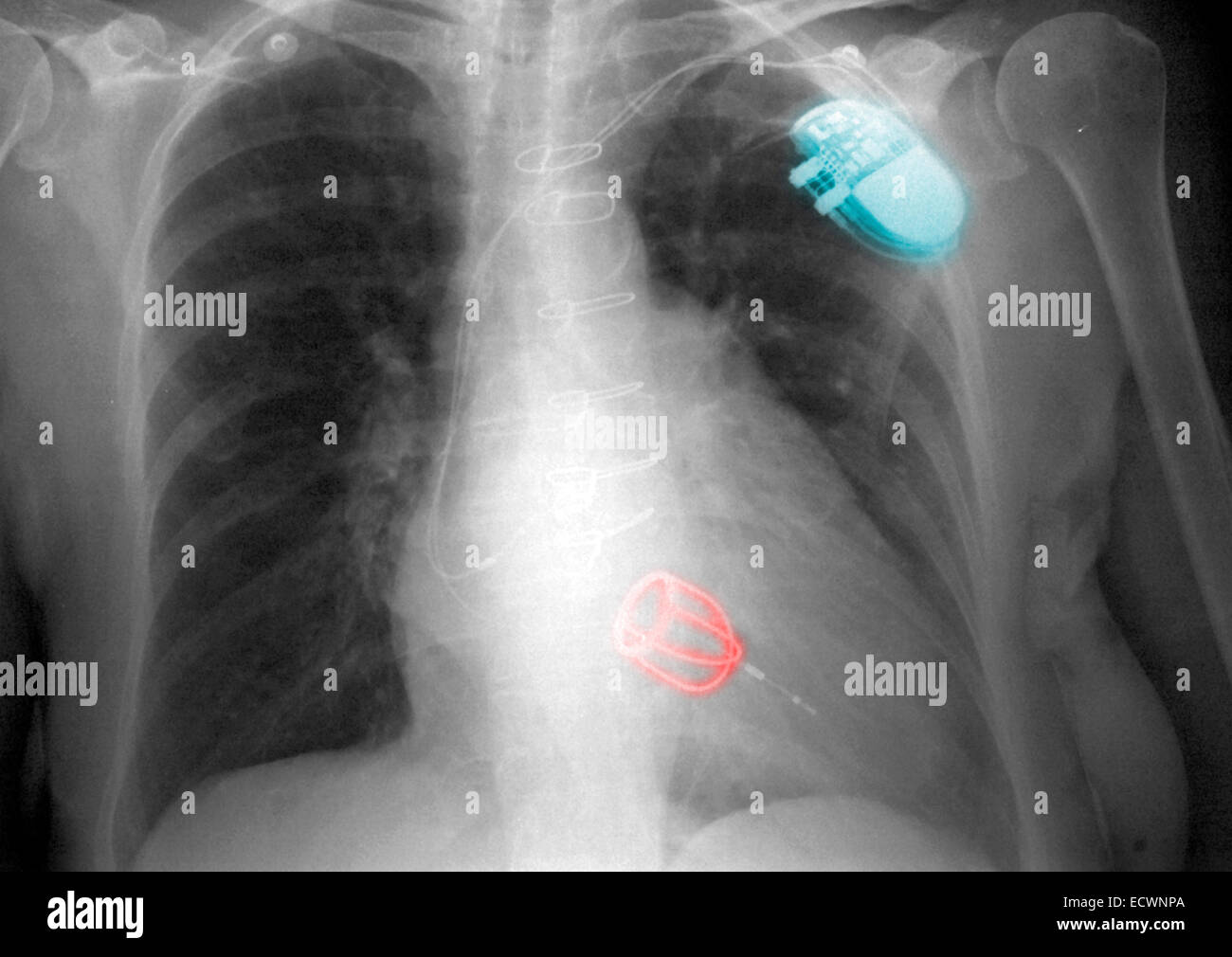 Starr-Edwards heart valve Stock Photo - Alamy Starr-Edwards heart valve Stock Photo - Alamy