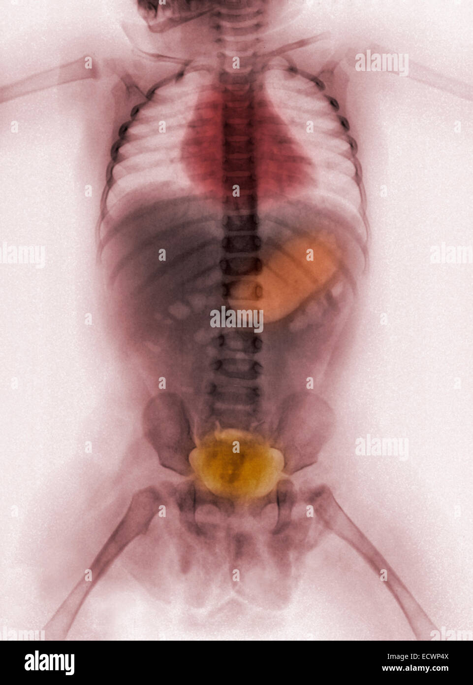 normal body x-ray of a 51 week old female child Stock Photo - Alamy