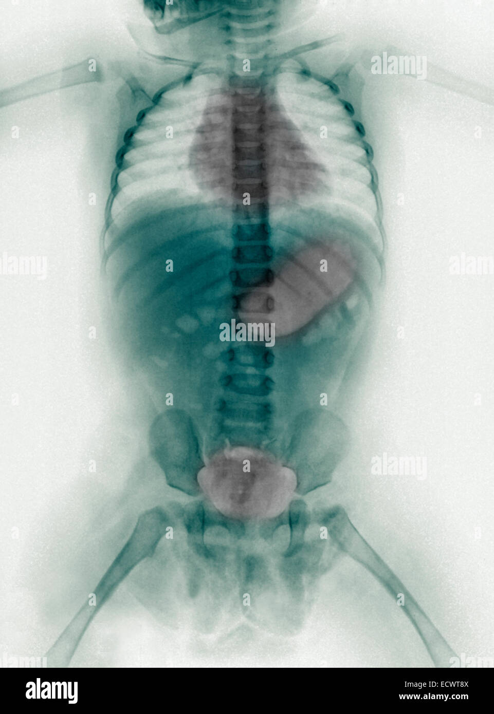 Chest X Ray Of Child Stock Photos & Chest X Ray Of Child Stock Images ...