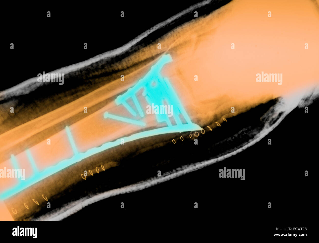 X-ray showing surgical repair an ankle fracture dislocation Stock Photo ...