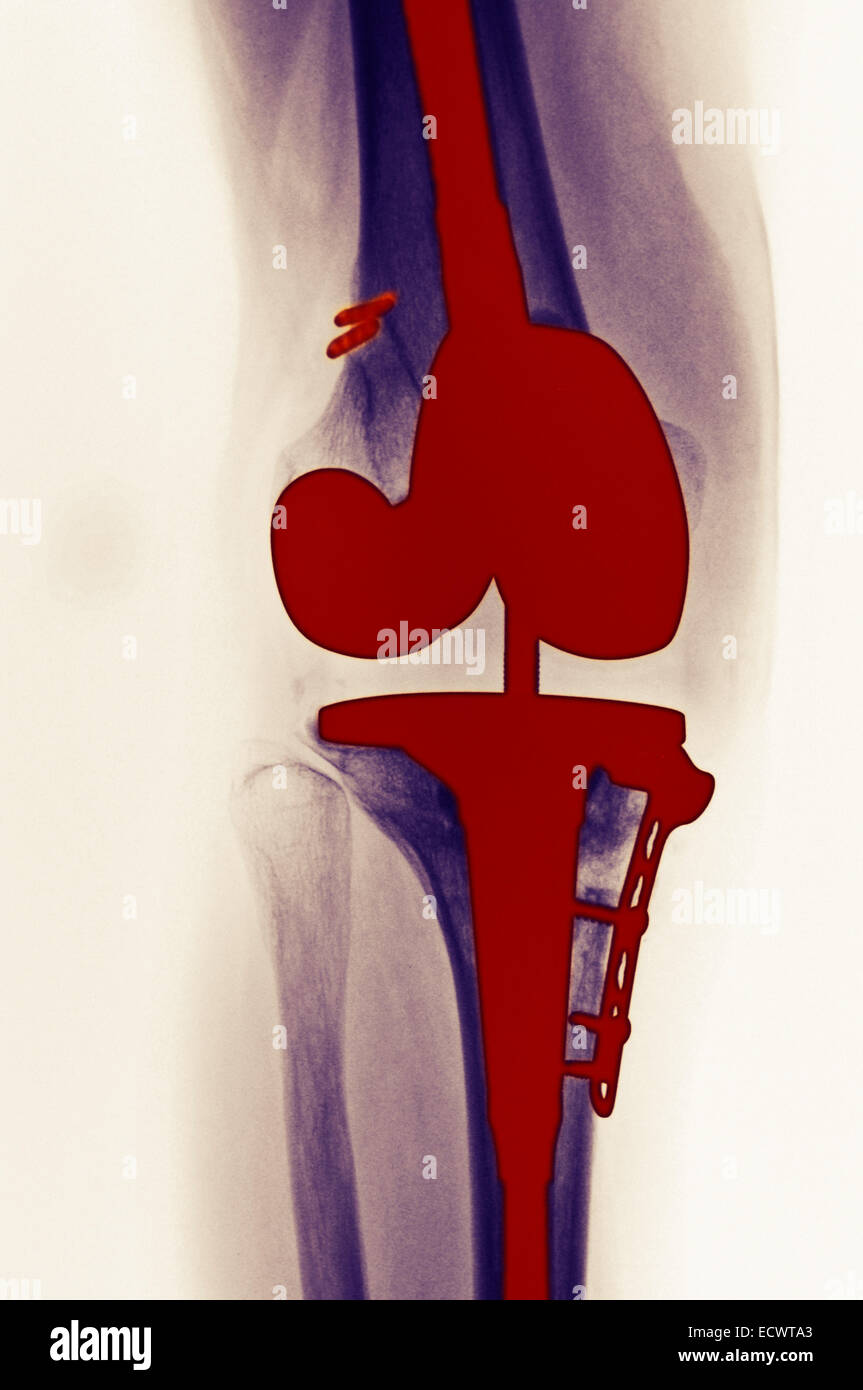 Total knee replacement hi-res stock photography and images - Alamy