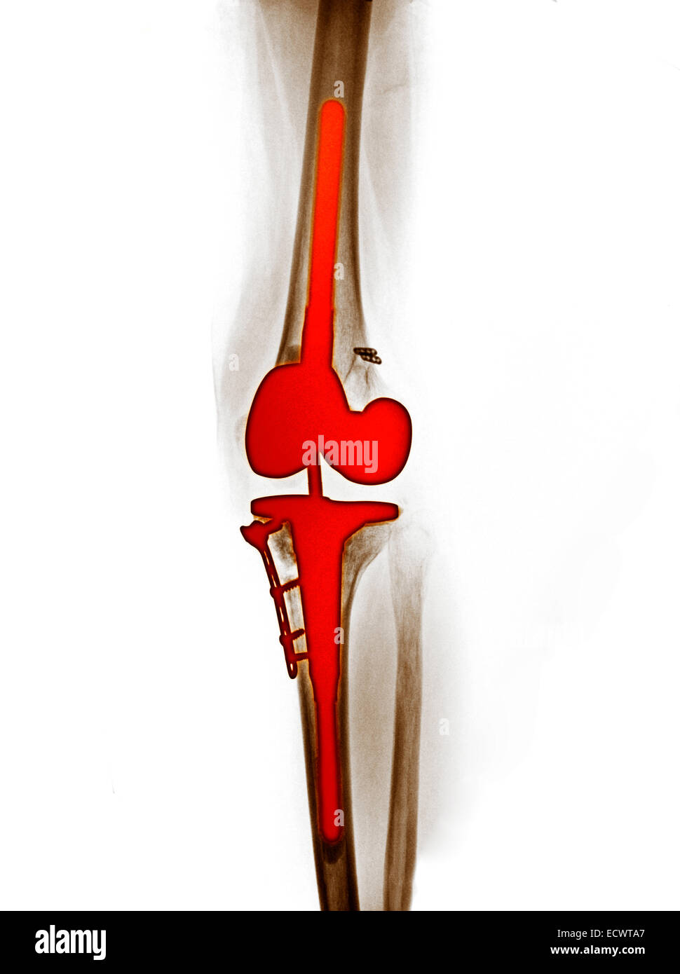 Total knee surgery hi-res stock photography and images - Alamy