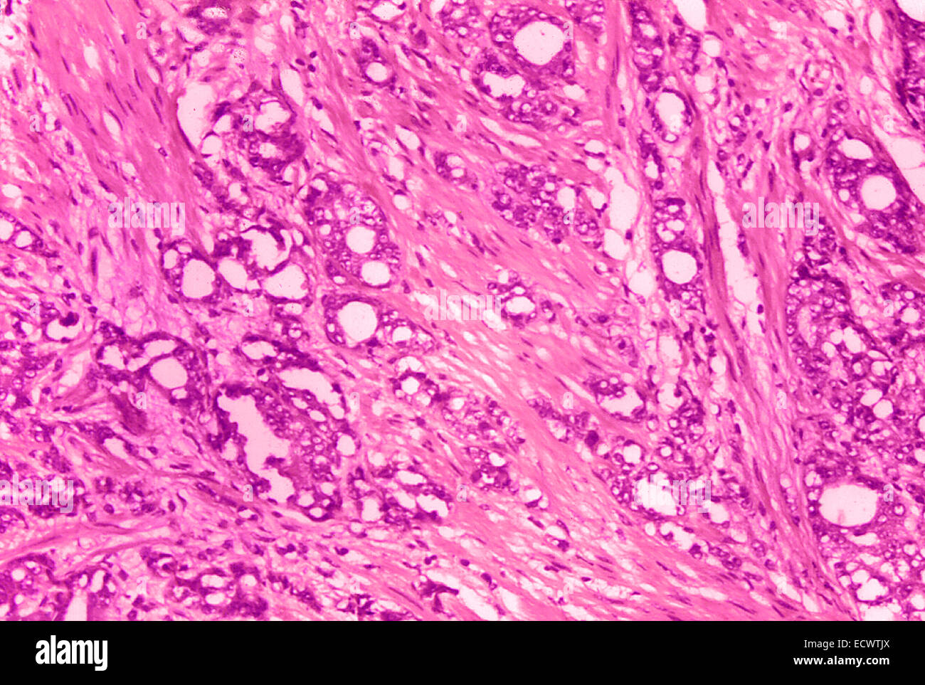 Light microscope image of adenocarcinoma of the prostate Stock Photo ...