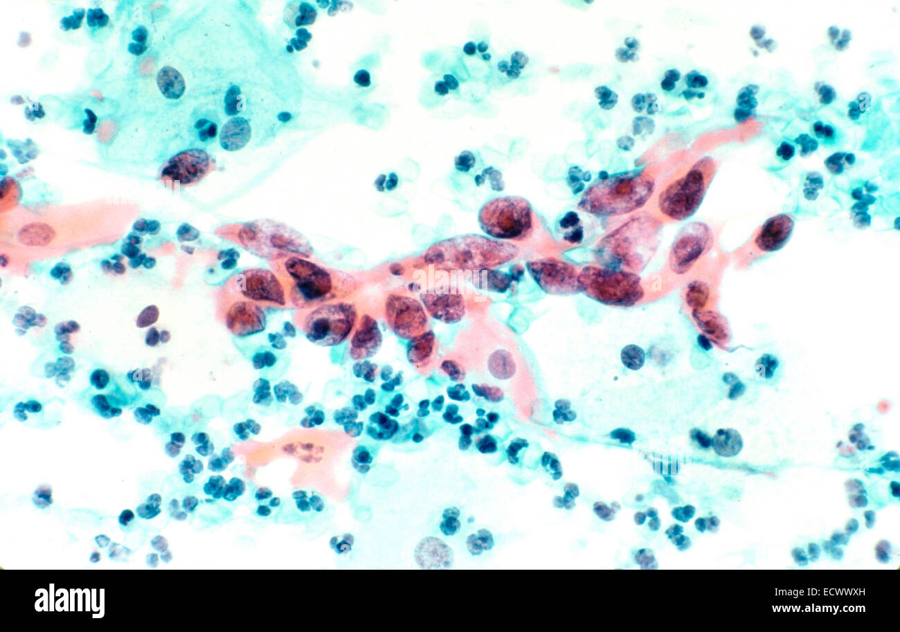 Squamous cell carcinoma in the cervix Stock Photo - Alamy Squamous cell carcinoma in the cervix Stock Photo - Alamy