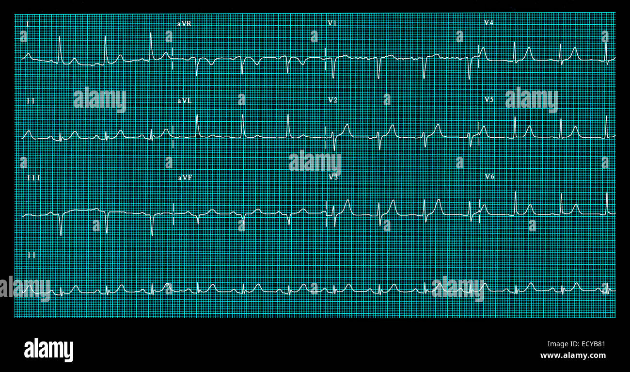 Normal sinus rhythm hi-res stock photography and images - Alamy