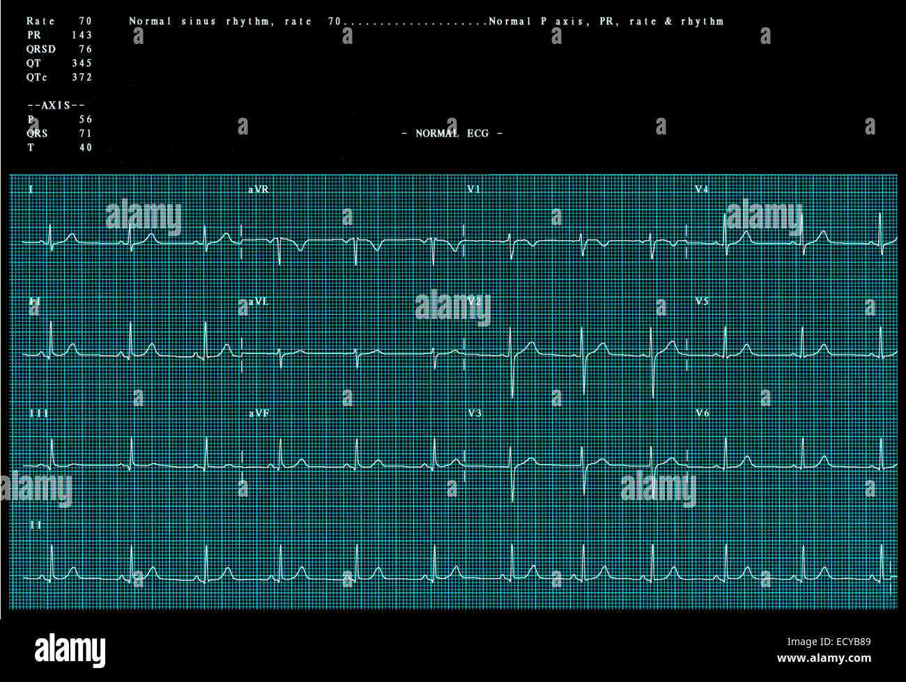 Segment Normal Heart Beat