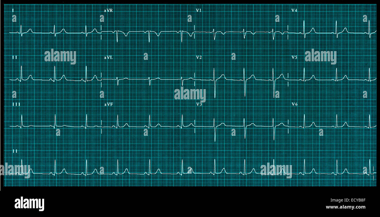 Normal ecg hi-res stock photography and images - Alamy
