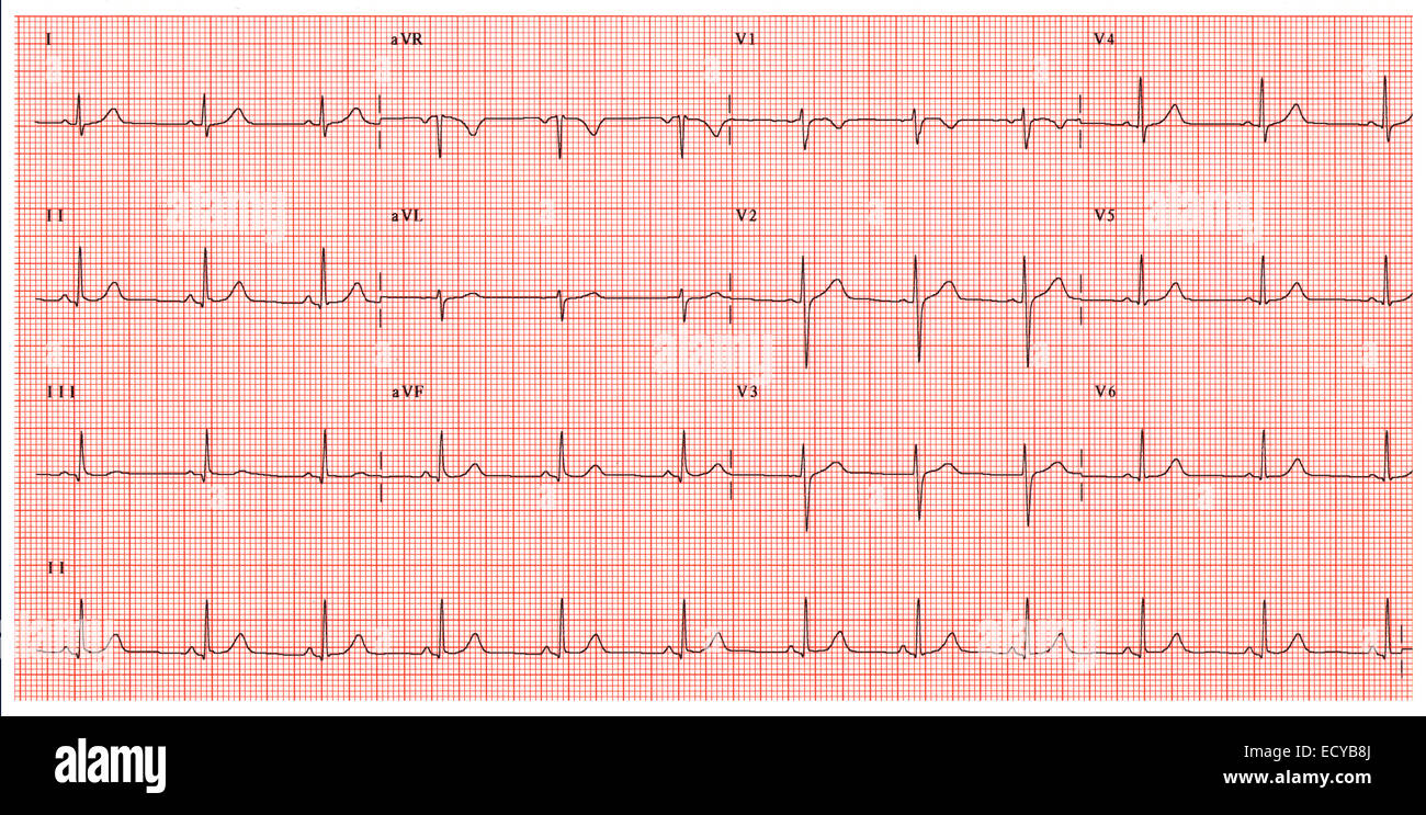 Normal electrocardiogram Stock Photo - Alamy Normal electrocardiogram Stock Photo - Alamy