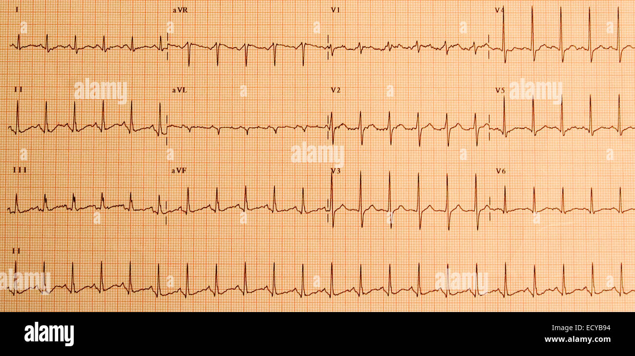Abnormal electrocardiogram showing a sinus tachycardia Stock Photo - Alamy