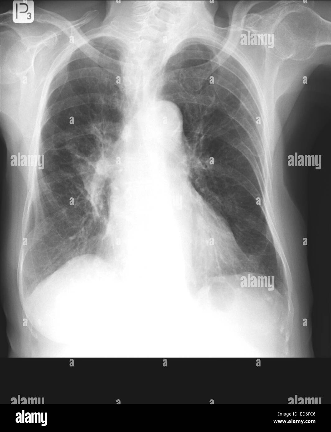 Chest x rays during lungs tuberculosis hi-res stock photography and ...