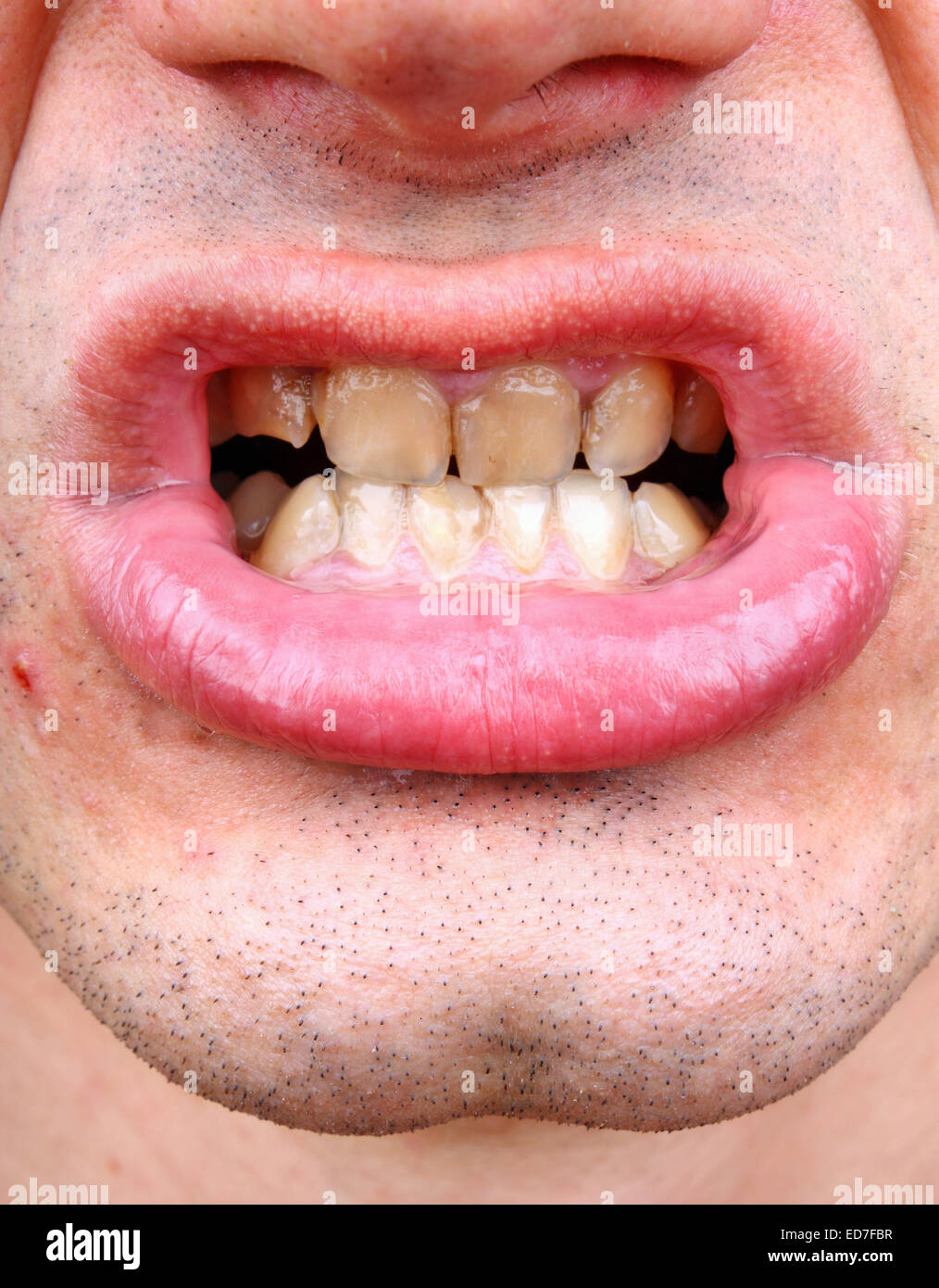 Diseased teeth of the patient. Tartar and tooth decay Stock Photo - Alamy