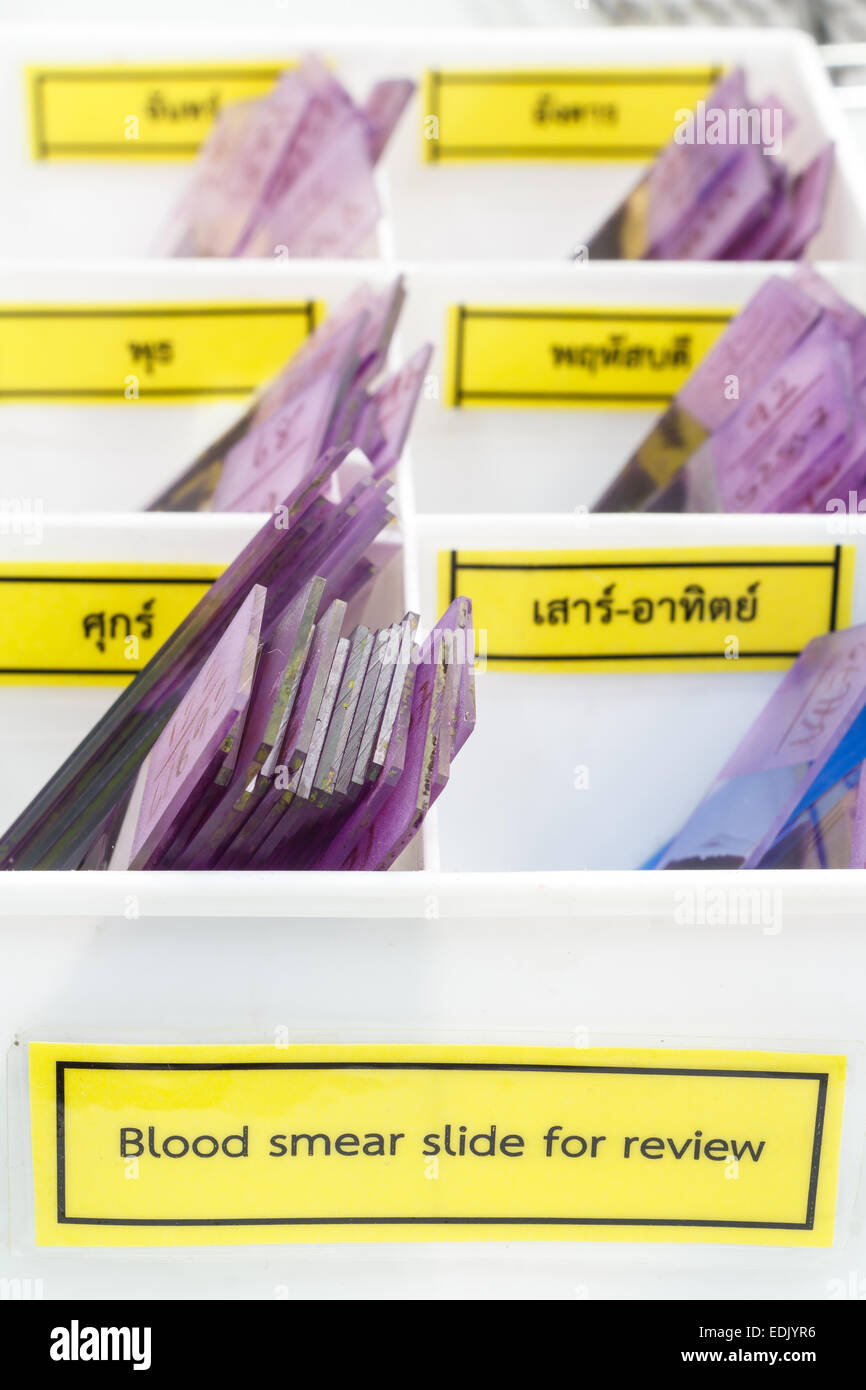 Peripheral Blood Smear (PBS) on glass side in hospital's laboratory ...