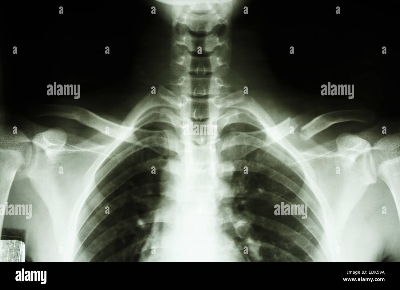 Xray Pictures Of A Broken Collarbone Biological Science
