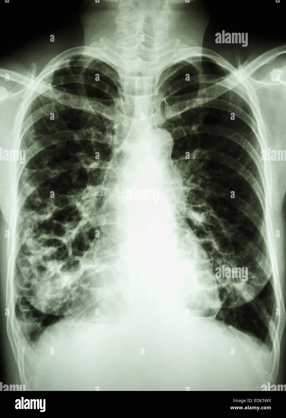 Black Lung Disease High Resolution Stock Photography and Images - Alamy