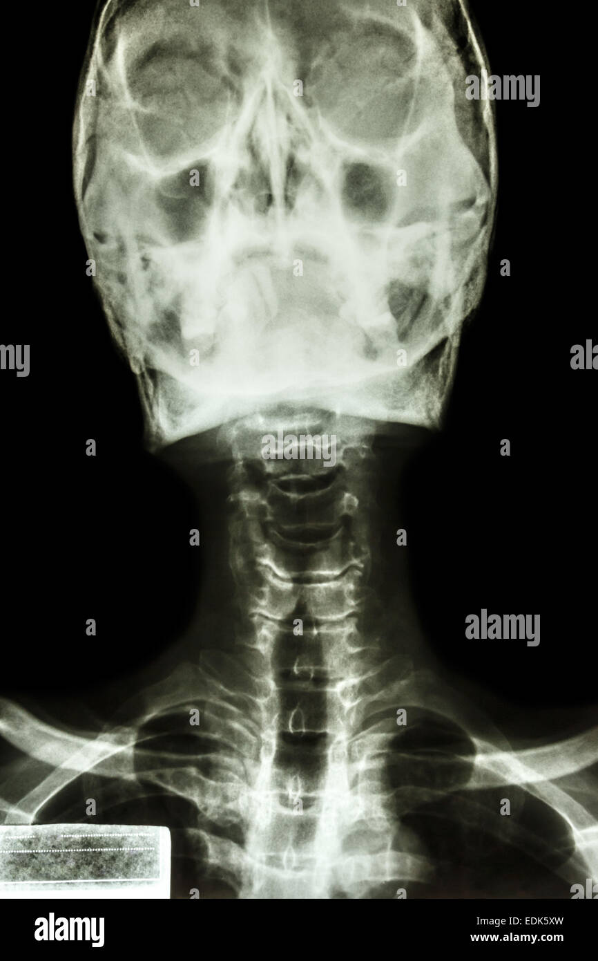 Normal neck x ray hi-res stock photography and images - Alamy