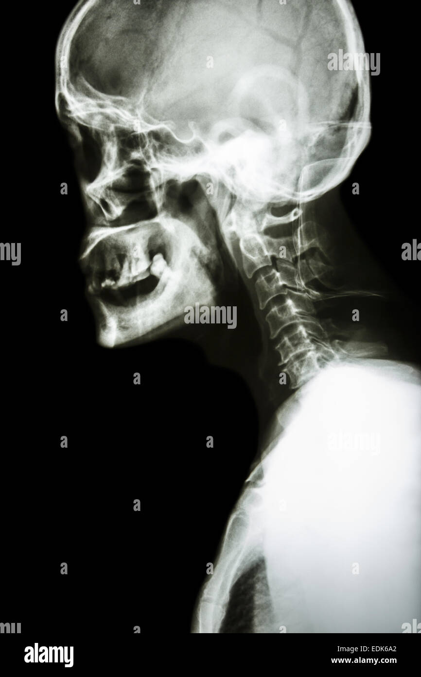 Normal neck x ray hi-res stock photography and images - Alamy