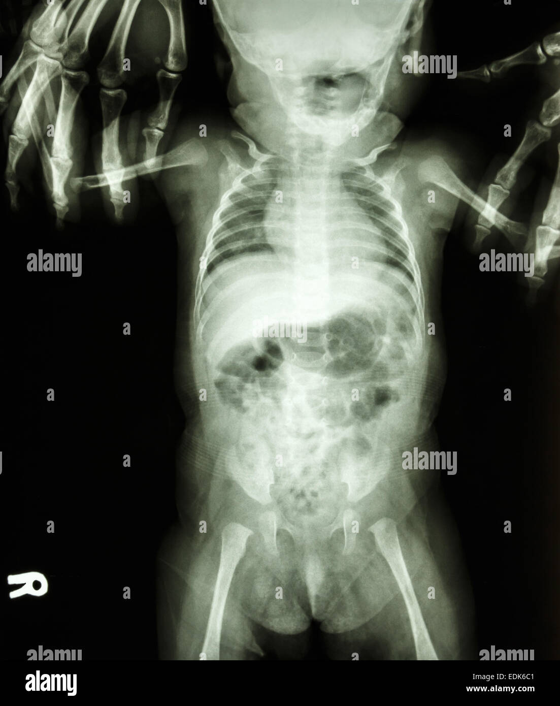 Xray Hand Child High Resolution Stock Photography and Images - Alamy