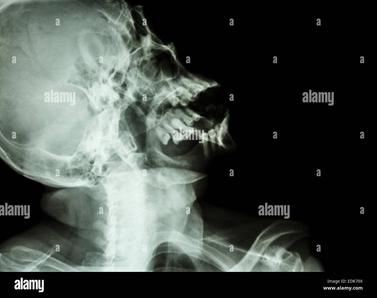 Normal Skull X Ray High Resolution Stock Photography and Images - Alamy