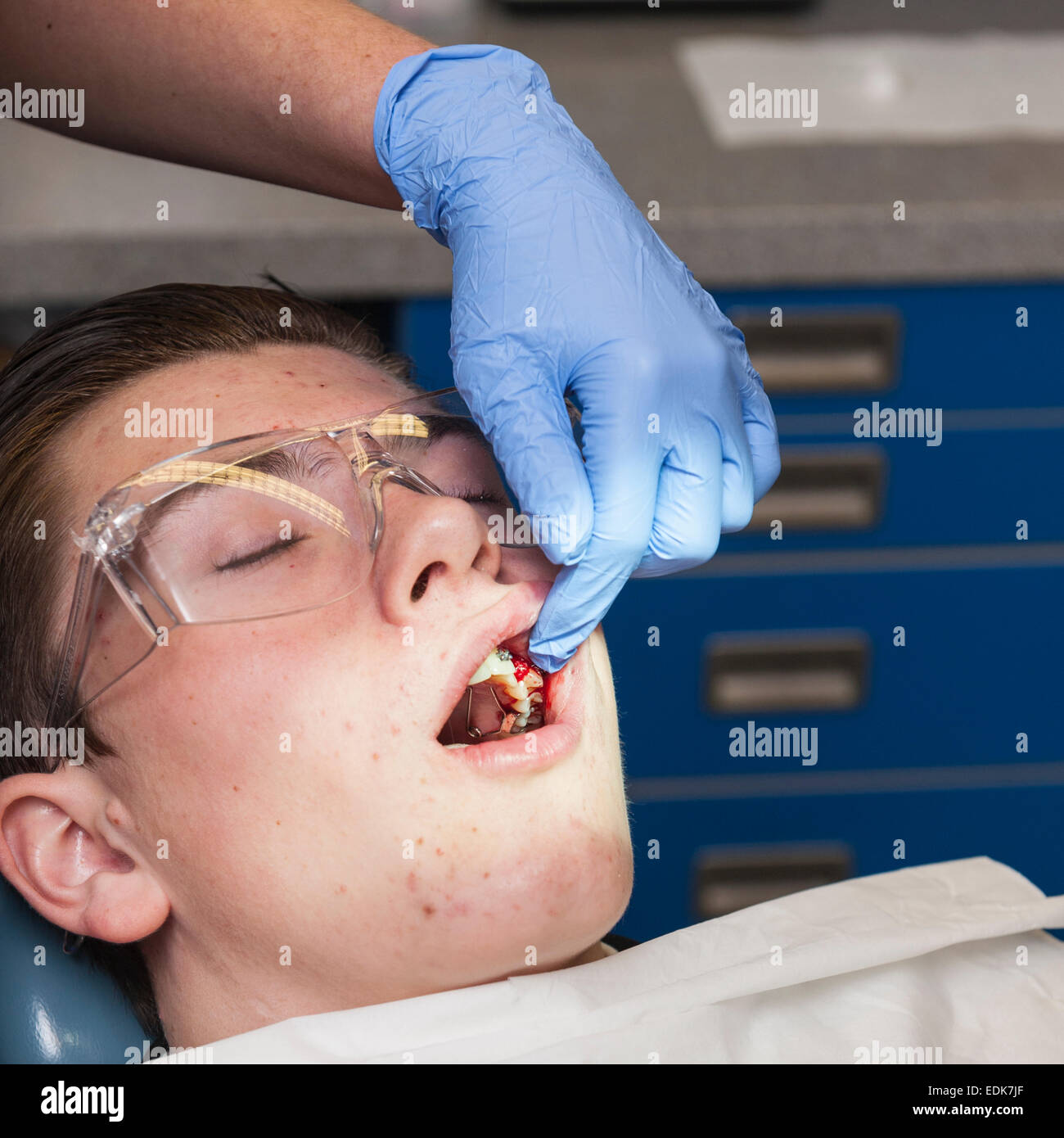 A 14 year old boy having a tooth extracted at the dentists in the Uk ...