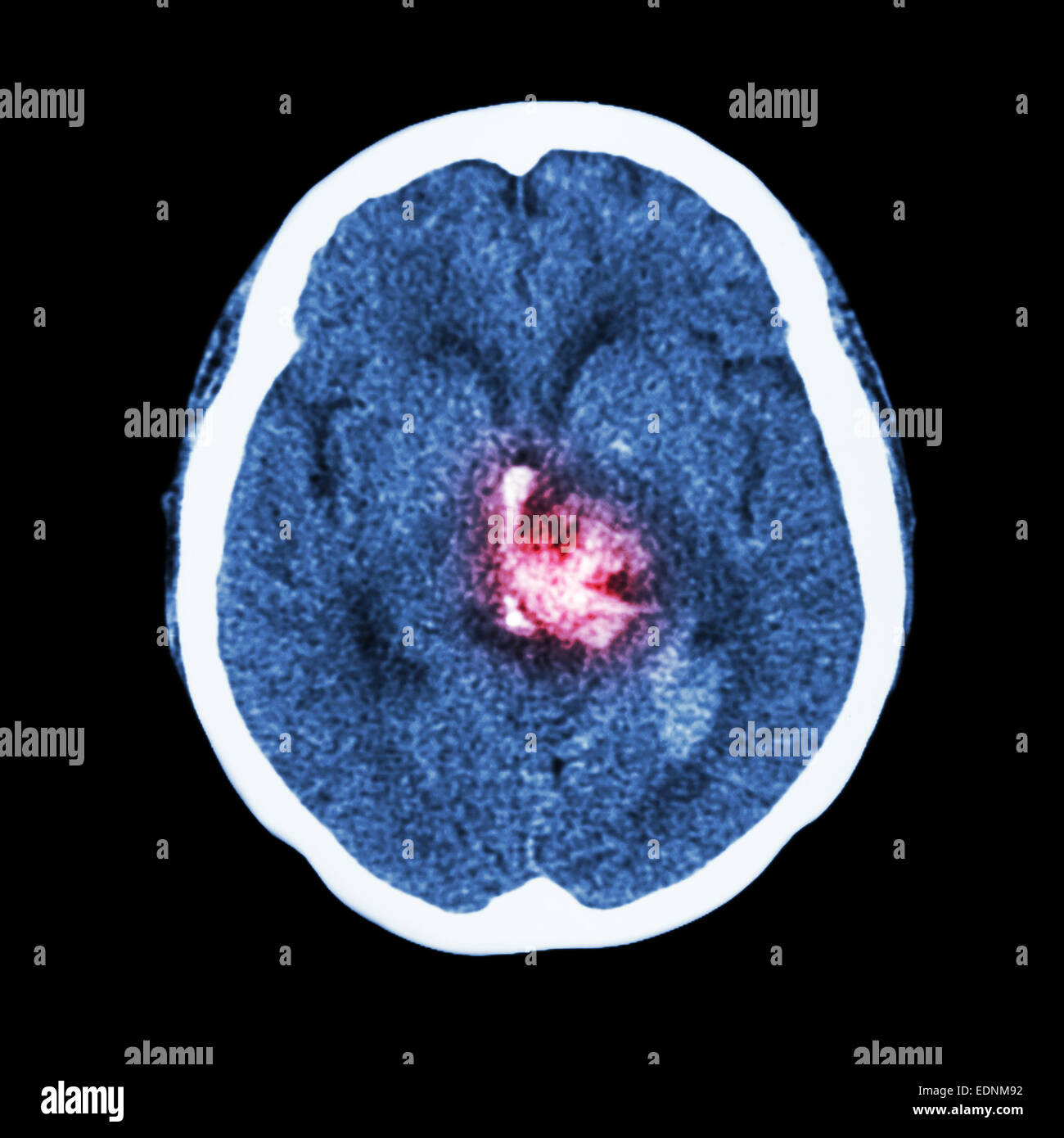 Hemorrhage, Brain Scan High Resolution Stock Photography and Images - Alamy