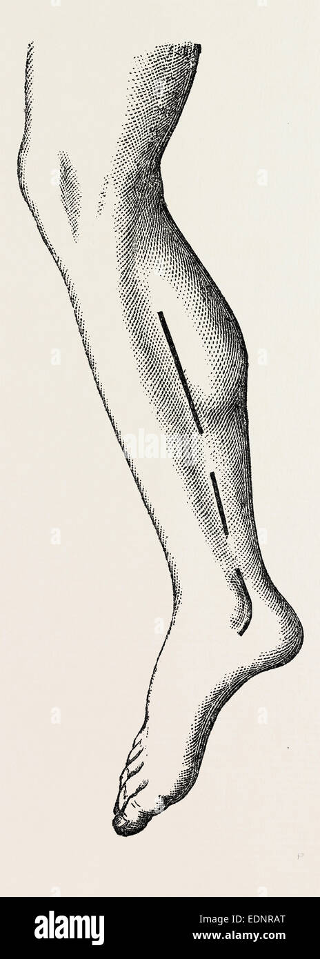 ligature, medical equipment, surgical instrument, history of medicine ...