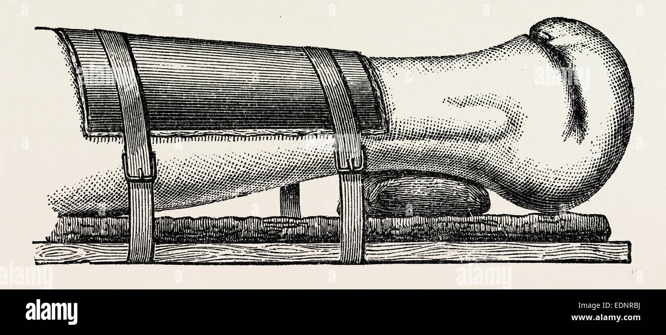 supporting splint adjusted to the leg, medical equipment, surgical ...