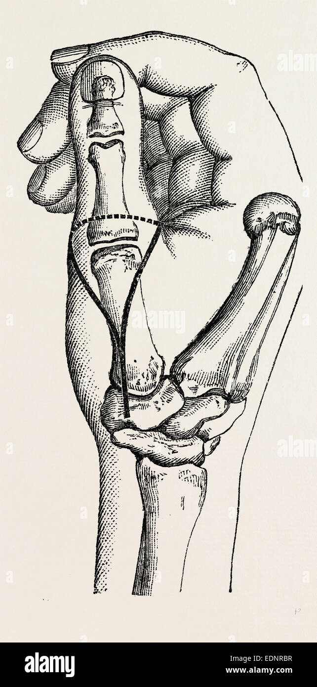 disarticulation, medical equipment, surgical instrument, history of ...