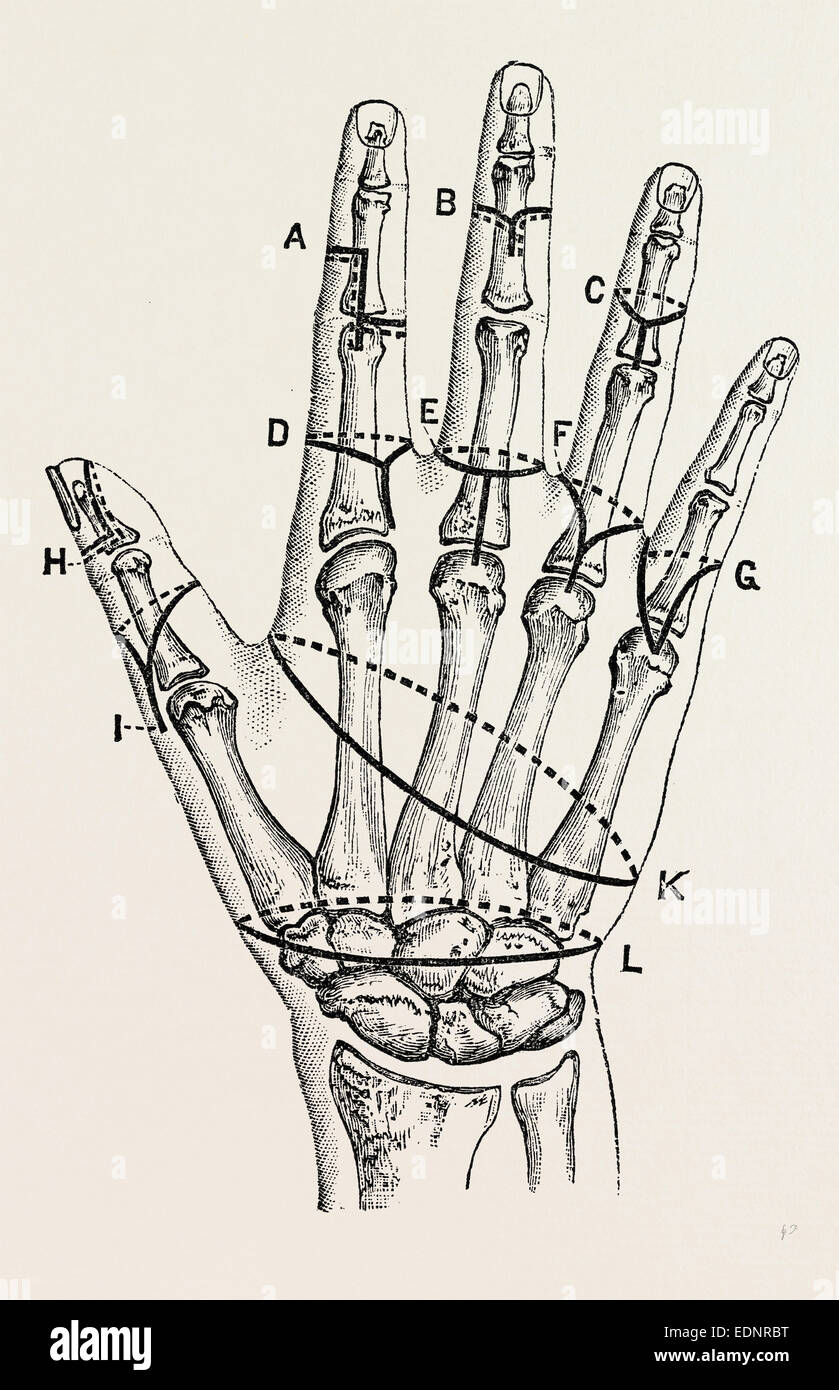 Disarticulation hi-res stock photography and images - Alamy