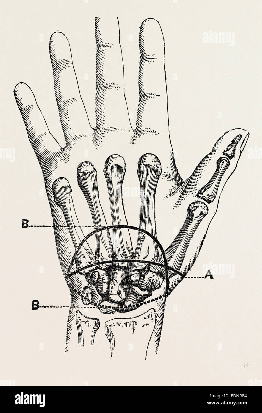 Palmar incision hi-res stock photography and images - Alamy