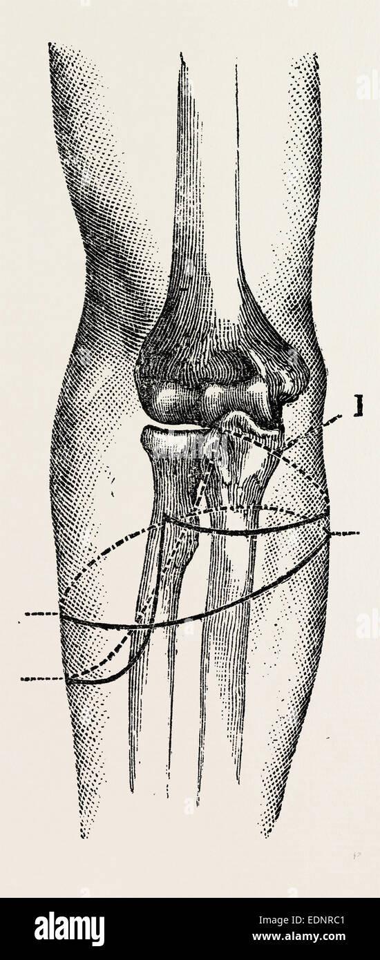 disarticulation, medical equipment, surgical instrument, history of ...