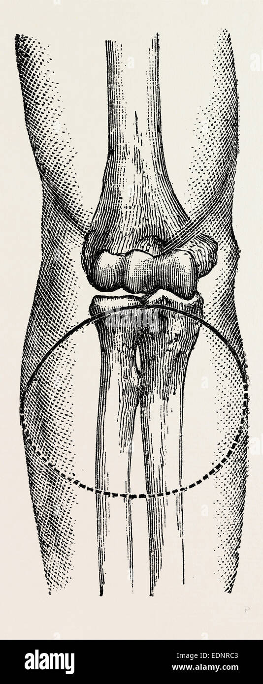 Disarticulation hi-res stock photography and images - Alamy