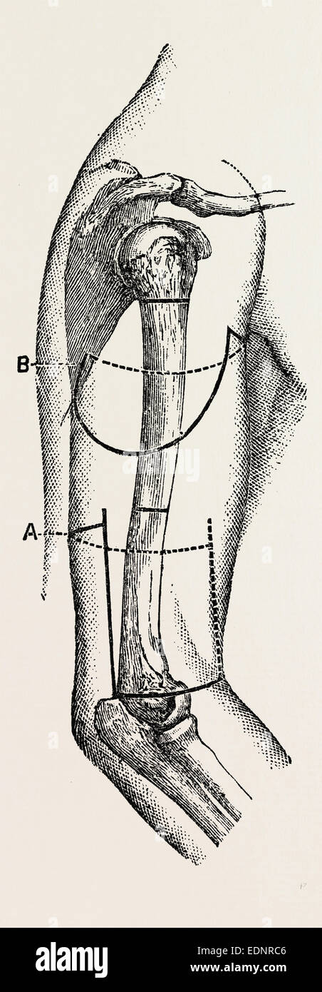 amputation, medical equipment, surgical instrument, history of medicine ...