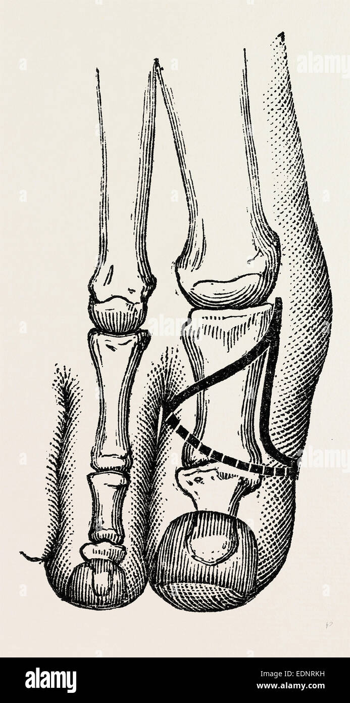 disarticulation, medical equipment, surgical instrument, history of ...