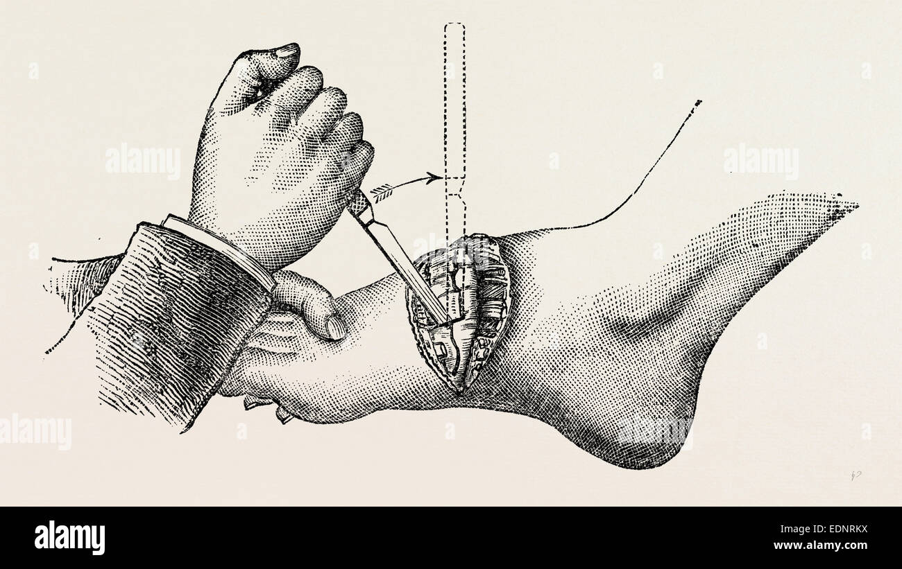 the coup de maitre in lisfrancis amputation, second step, medical ...