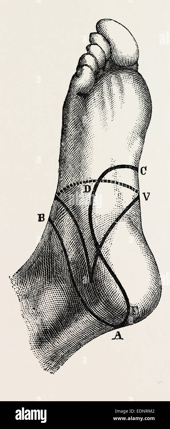 inner and outer sides of the right foot, to show the incisions, medical ...