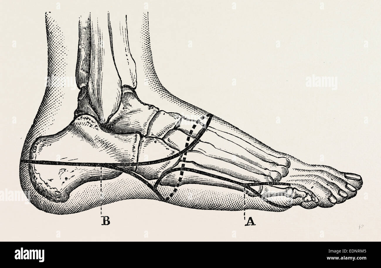 disarticulation of the little toe, medical equipment, surgical ...