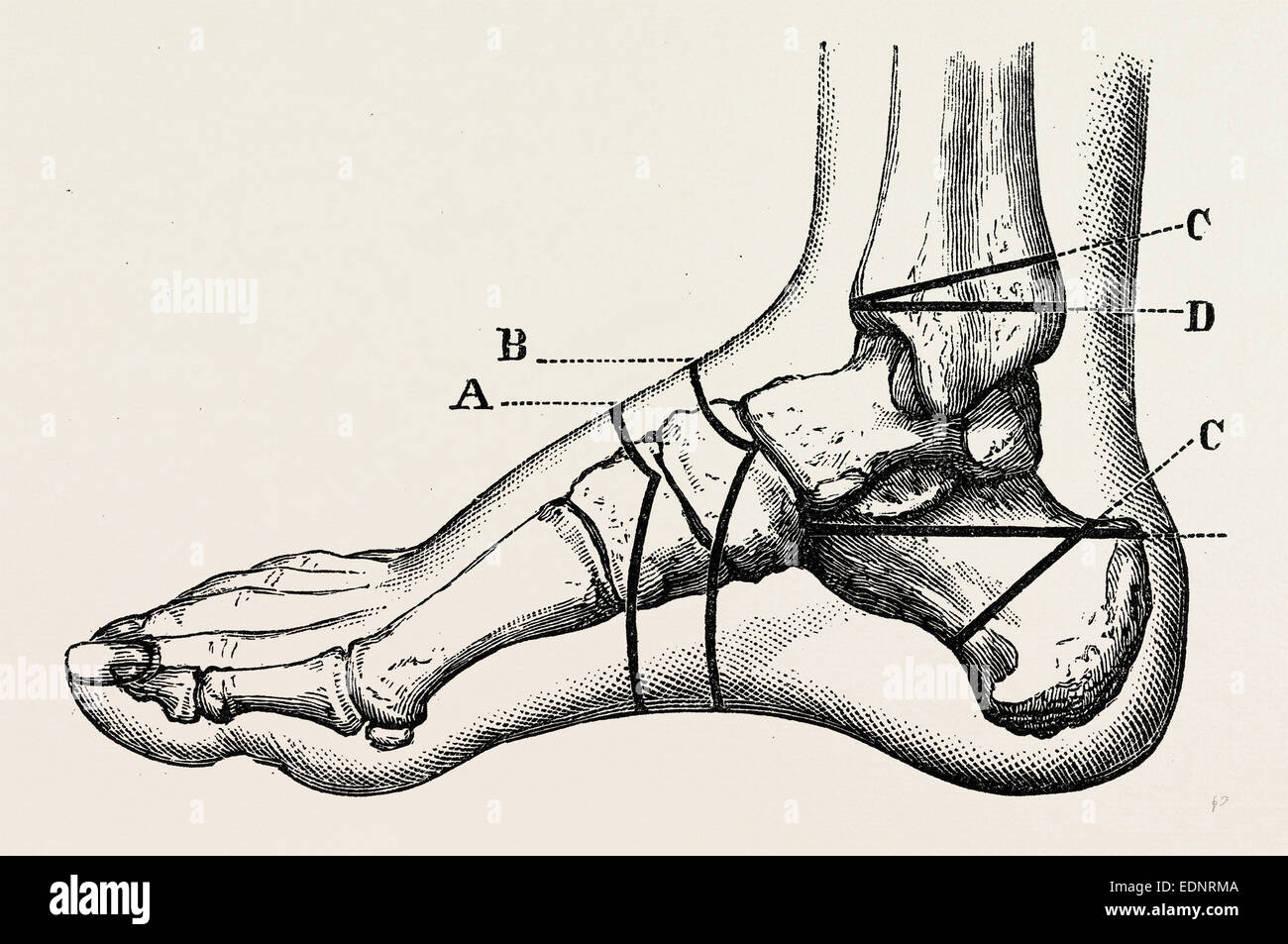 Farabeufs hi-res stock photography and images - Alamy