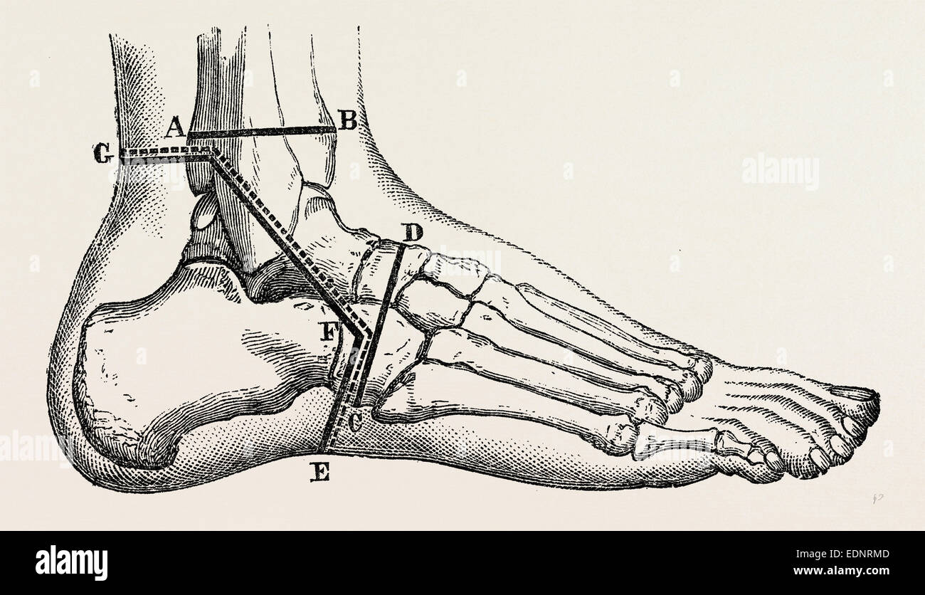 Osteo plastic resection foot hi-res stock photography and images - Alamy