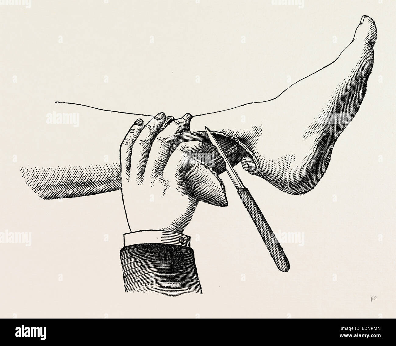 Surgical Amputation Stock Photos & Surgical Amputation Stock Images - Alamy