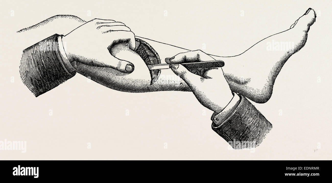 mode of cutting the flap in the amputation at 44, medical equipment ...