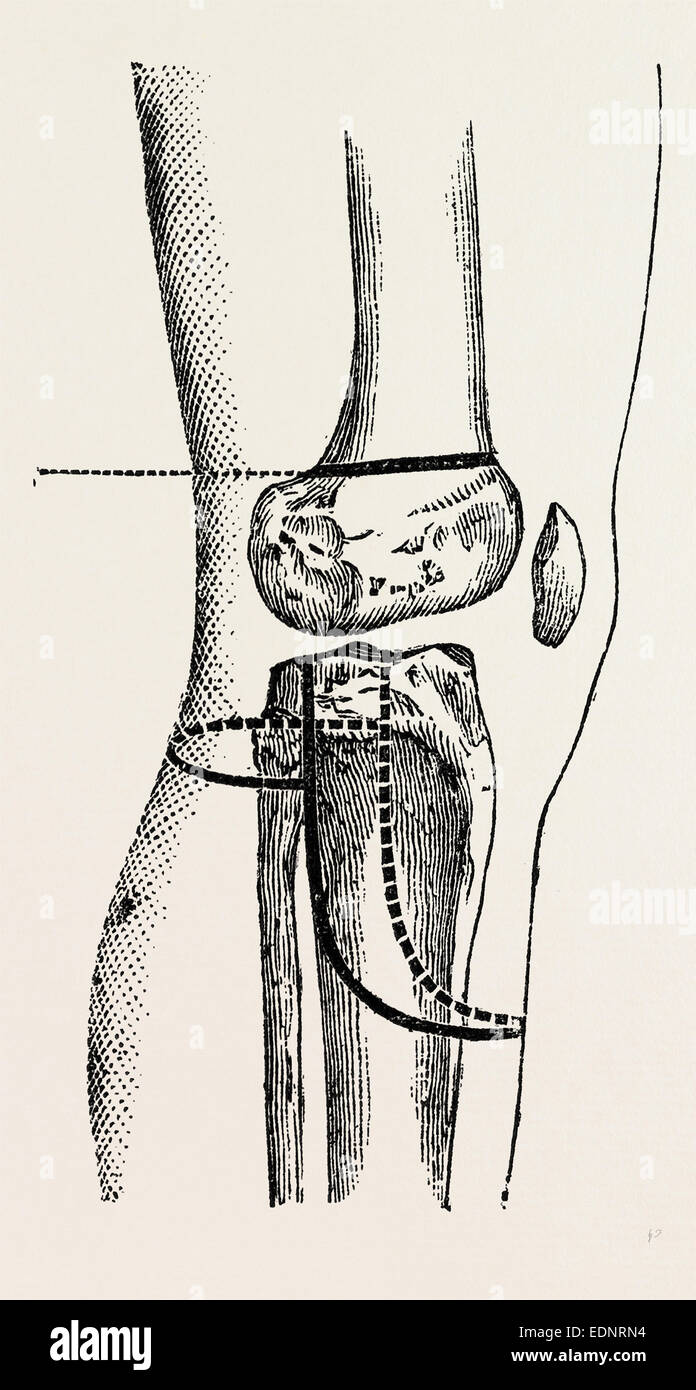 farabeuf's amputation, medical equipment, surgical instrument, history ...
