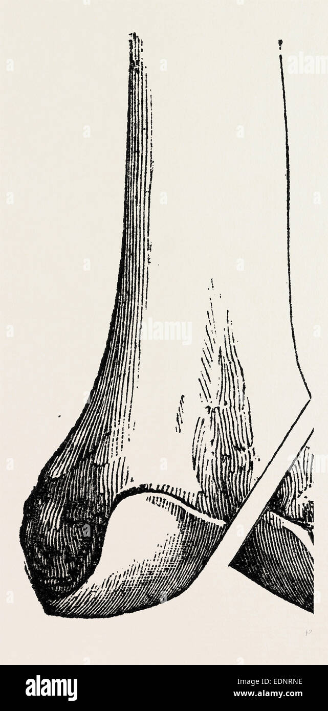 Ogstons operation hi-res stock photography and images - Alamy