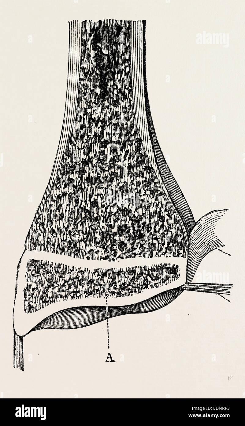 radio-car lower end of the radius, medical equipment, surgical ...
