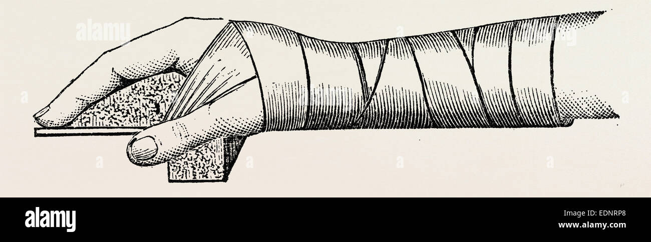 lister' s splint for excision, medical equipment, surgical instrument ...