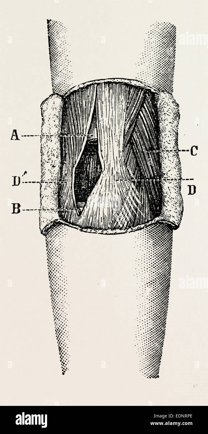 right elbow after excision, medical equipment, surgical instrument ...
