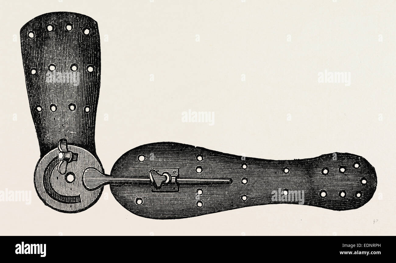 mason's splint for excision of the elbow, medical equipment, surgical ...