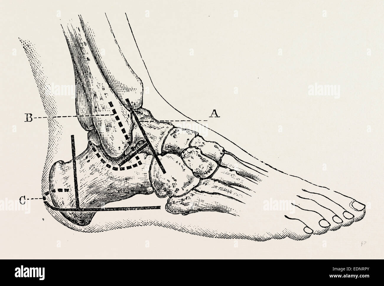 excision of astragalus, outer incision, medical equipment, surgical ...