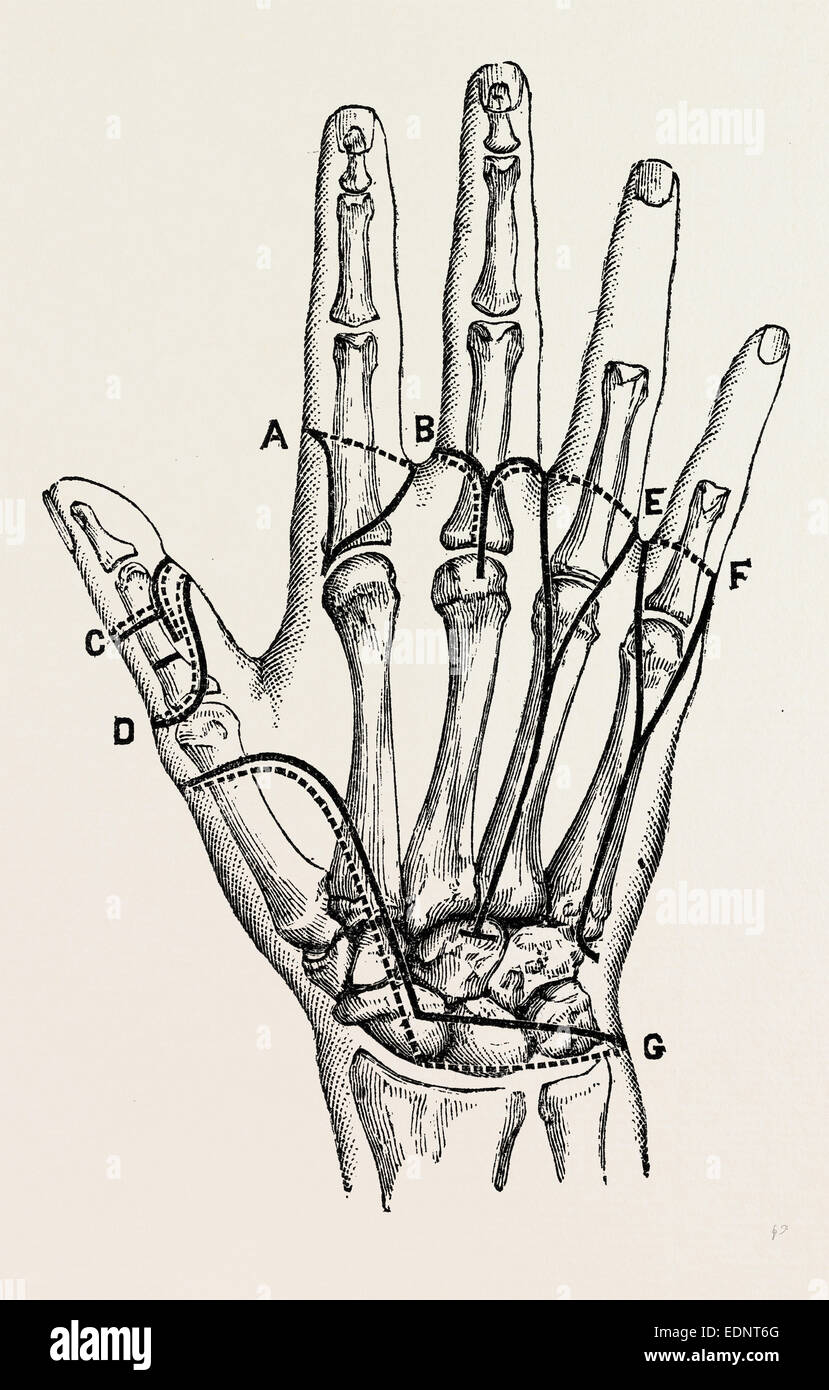 Disarticulation hi-res stock photography and images - Alamy