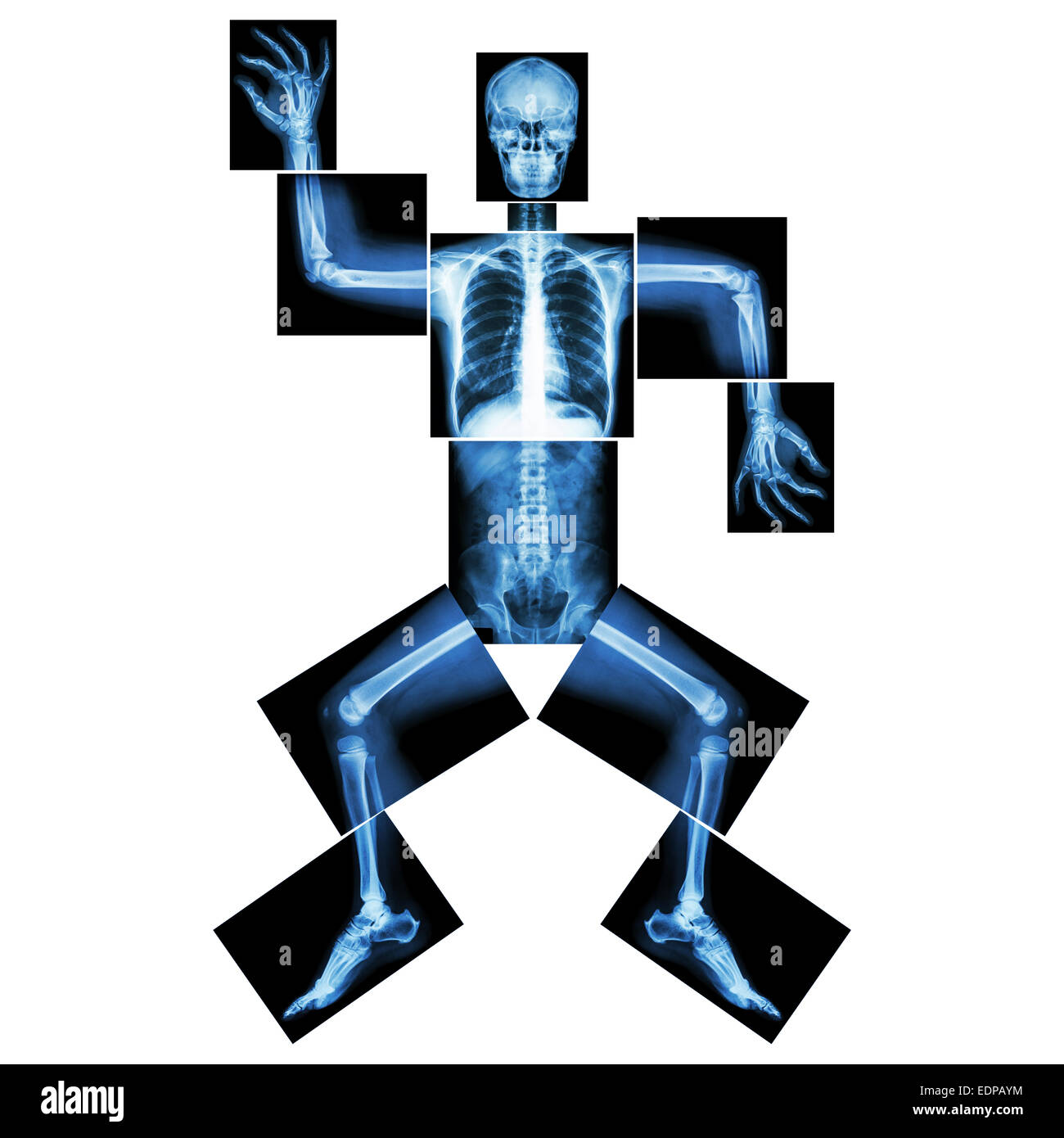 Aerobic Dance(human bone is dancing),(Whole body x-ray : head ,neck ...